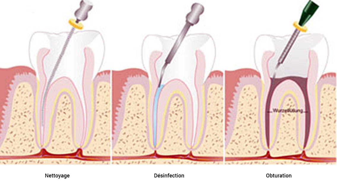 Traitements de canal | Services | Clinique dentaire Dr Benoit Bousquet ...